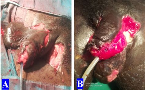 Uncommon Scrotal Trauma Insights From Four Distinct Cases And Review