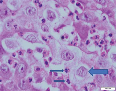 Neutrophil Aggregates In The Cytoplasm Of The Tumor Cells Degenerative