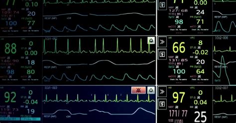 Telemetry Is Key For Treating Patients Improper Monitoring Can Lead To