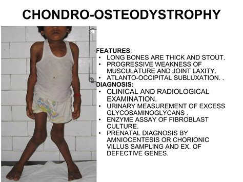 Morquio Syndrome Ppt