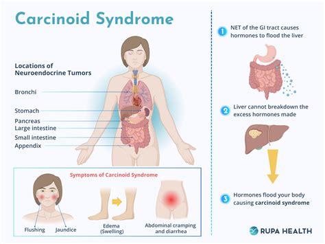What Is Carcinoid Syndrome And How Can Functional Medicine Help
