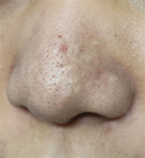 What Is Wrong With My Nose Its Bumpy R Skincareaddicts