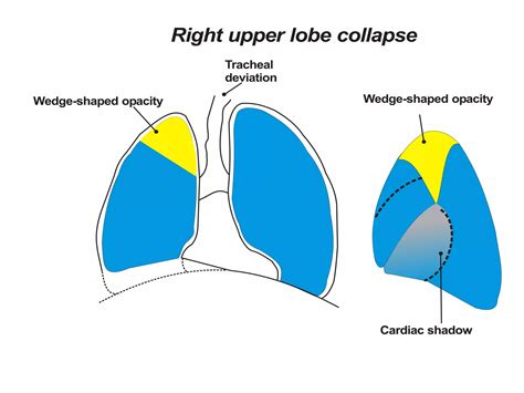 Collapse And Consolidation Lung Radiology Ppt