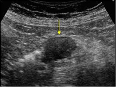 Abdomen And Retroperitoneum 1 8 Various Intra Abdominal Tumors Case 1 8 1 Various Malignant