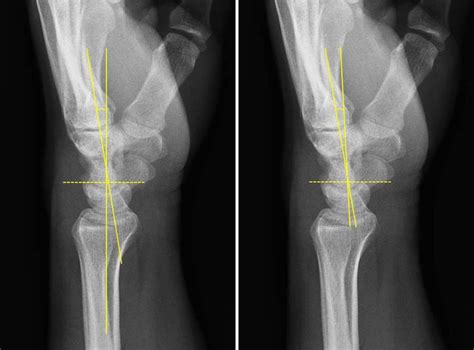 X Ray Wrist Lateral View
