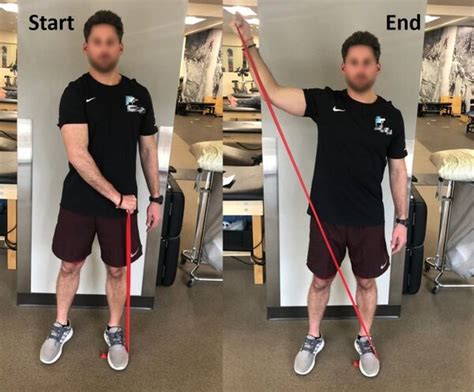 Latarjet Procedure Physiopedia