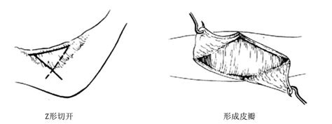 关节瘢痕挛缩畸形修复术 手术图解 医学图库