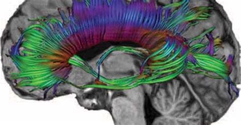 Diffusion Tensor Imaging Dr Shock Md Phd