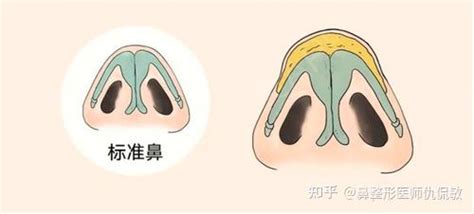鼻头肥大是什么原因造成的 知乎