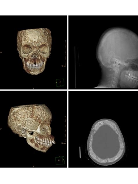 Severe Secondary Hyperparathyroidism International Journal Of