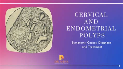 Cervical And Endometrial Polyp Cause And Treatment
