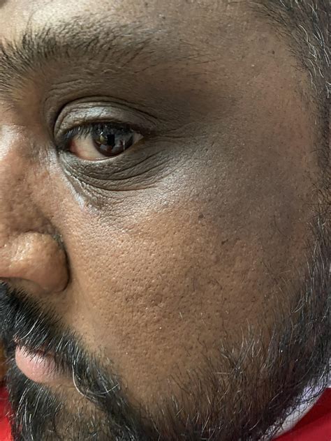 Hyperpigmentation Around Eye And Cheek I Tried Using Baking Soda And