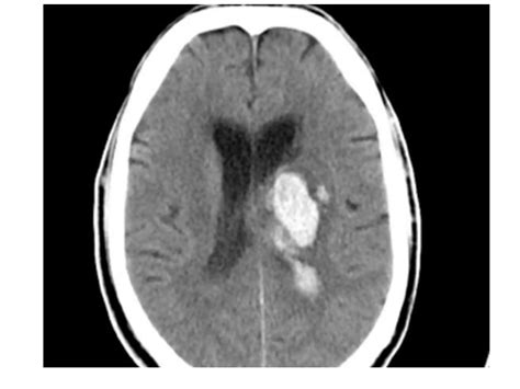 Thalamus And Its Connection Pptx