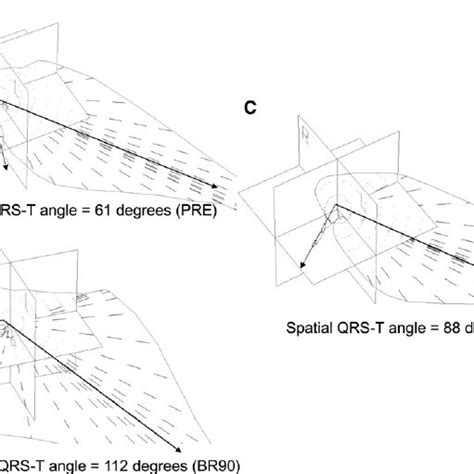 Representative Dimensional Vectorcardiographic Loops With Download Scientific Diagram