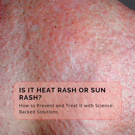 Is It Heat Rash Or Sun Rash How To Prevent And Treat It With Science