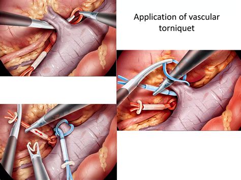 Laparoscopic Partial Nephrectomy Ppt