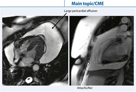 8 Large Pericardial Effusion Bright Area With A Typical Swinging Download Scientific Diagram
