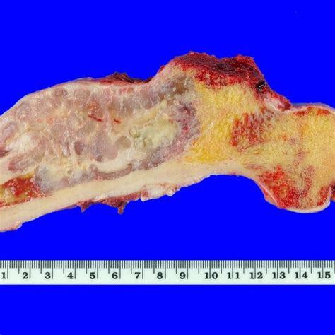 Chondrosarcoma Is In The Proximal Femoral Shaft And Not In Head Or Neck Download Scientific