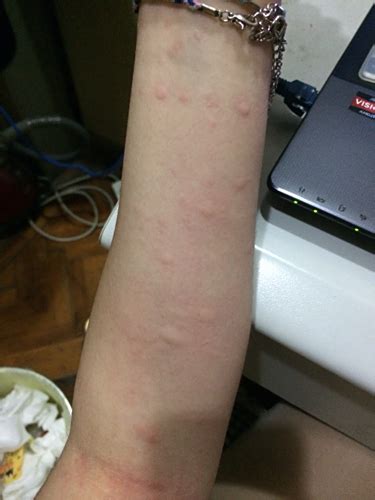 身上长籽籽很痒图片腿上长红疙瘩很痒图片 伤感说说吧