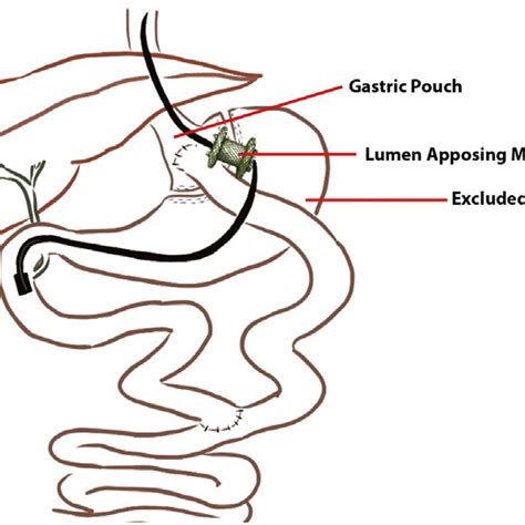 PDF EUS Directed Transgastric ERCP In Roux En Y Gastric Bypass Revision Of Sleeve Gastrectomy
