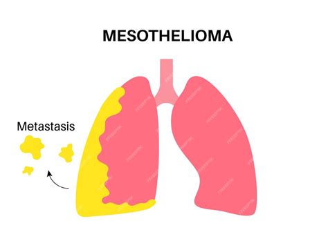 Premium Vector Mesothelioma Cancer Disease