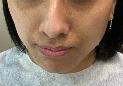 カバーメイク実演 ★レックリングハウゼン病と共に歩む事★生きやすい世の中へ1男5女のママブログ