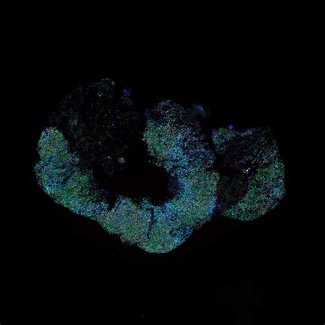 Charting New Territories In Hematology The Impact Of Spatial