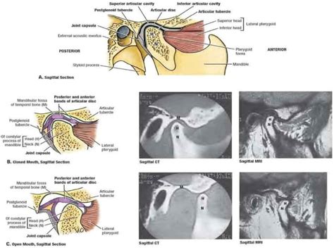 Temporal And Infratemporal Fossa 16 Pptx