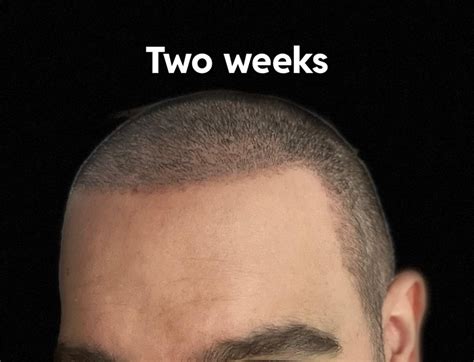 Struggling With Ugly Duckling Phase R Hairtransplants