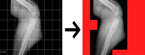 Figure 4 From Detection Of Osteosarcoma On Bone Radiographs Using Convolutional Neural Networks