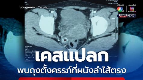 ข่าวเคสแปลก หญิงวัย 32 ปี เลือดออกช่องคลอด ตรวจเพิ่มเติมพบตั้งครรภ์ แต่หายังไงก็ไม่เจอว่า