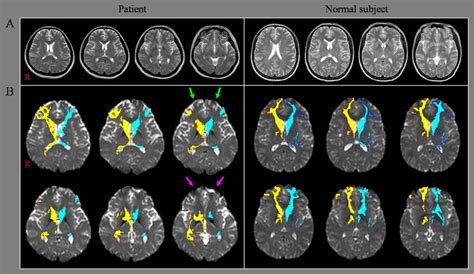 A T2 Weighted Brain Mr Images At Seven Months After Onset Show No