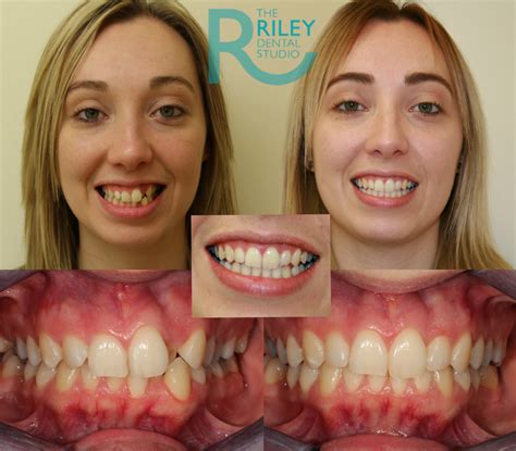 How Long Does It Take Before Invisalign Starts Working How Long Does