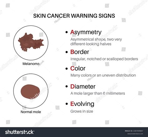 Melanoma Normal Mole Comparison Skin Cancer Stock Vector Royalty Free