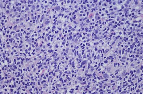 Marginal Zone Lymphoma Presentation At Multiple Mucosal Sites May Be