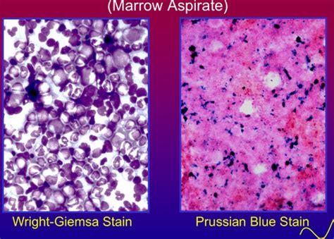 Lecture 10 Non Regenerative Anemias And Erythrocytosis Flashcards Quizlet