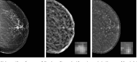 Figure 1 From Improving Mass Candidate Detection In Mammograms Via Feature Maxima Propagation