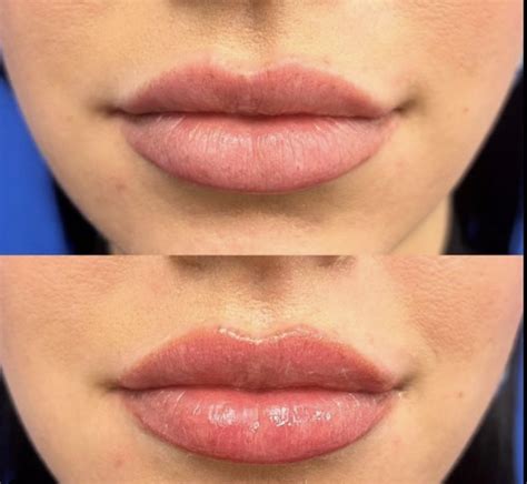 The Laser Lip Fiip Is The New Needle Free Way To Plump Thin Lips