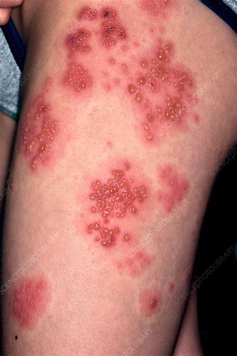 Shingles Rash Stock Image C0345530 Science Photo Library