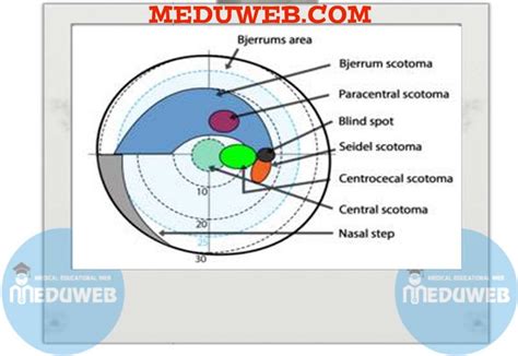 Summary Of Vf Defects Meduweb