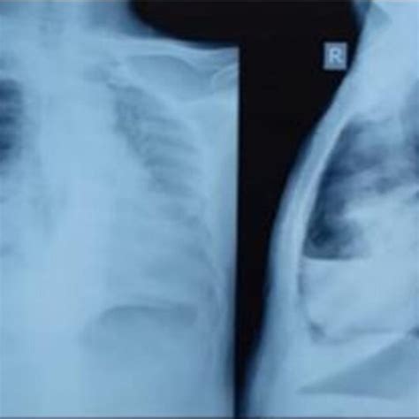 Cxr On Admission Revealed A Right Pneumothorax Pneumonia And Bullae Download Scientific
