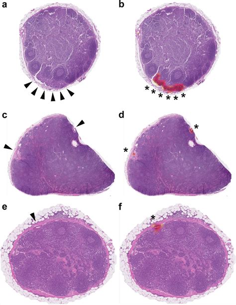Examples Of Micrometastasis In Our Singlelymph Node Level Testing Set Download Scientific