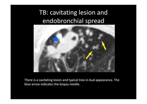 Interstitial Lung Diseases Radiology Ppt