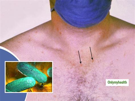 Learn About The Week By Week Symptoms Of Typhoid Onlymyhealth