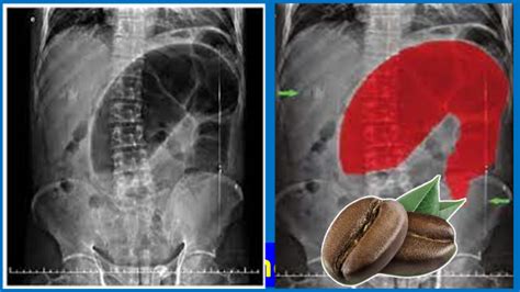 Queen Med Volvo De Sigmóide Causas