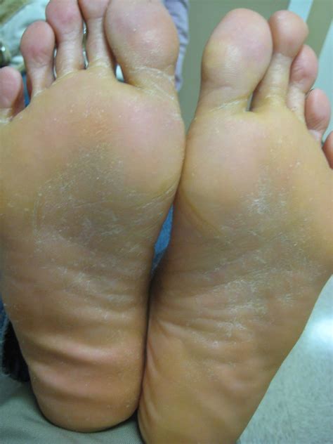 Xerosis Of Skin
