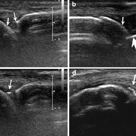 Radiograph Of The Third MCP Joint Of The First Subject During A Download Scientific Diagram