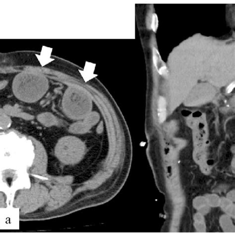 A B Ct Scan Imaging Of Jejunojejunostomy Obstruction Imaging Of Case Download Scientific A B Ct Scan Imaging Of Jejunojejunostomy Obstruction Imaging Of Case Download Scientific