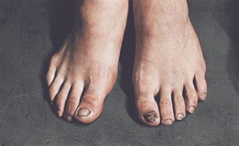새카만 발톱 멍 이유 있다255㎜ 작은발 손흥민의 비밀 중앙일보