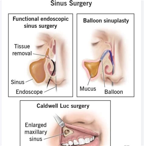 Nasal Polyps Removal Recovery